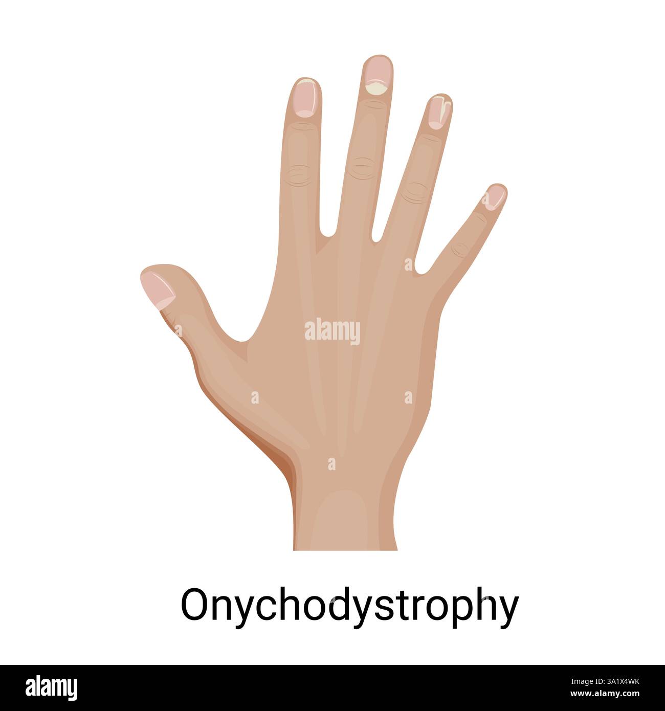 Onychodystrophy hi-res stock photography and images - Alamy