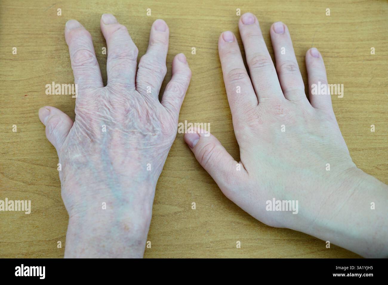 Comparison of Healthy Hand and Arthritic Hand. High quality photo Stock ...