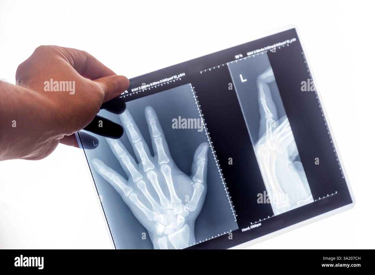 Doctors hand holding a digital x-ray image showing the bones of the ...