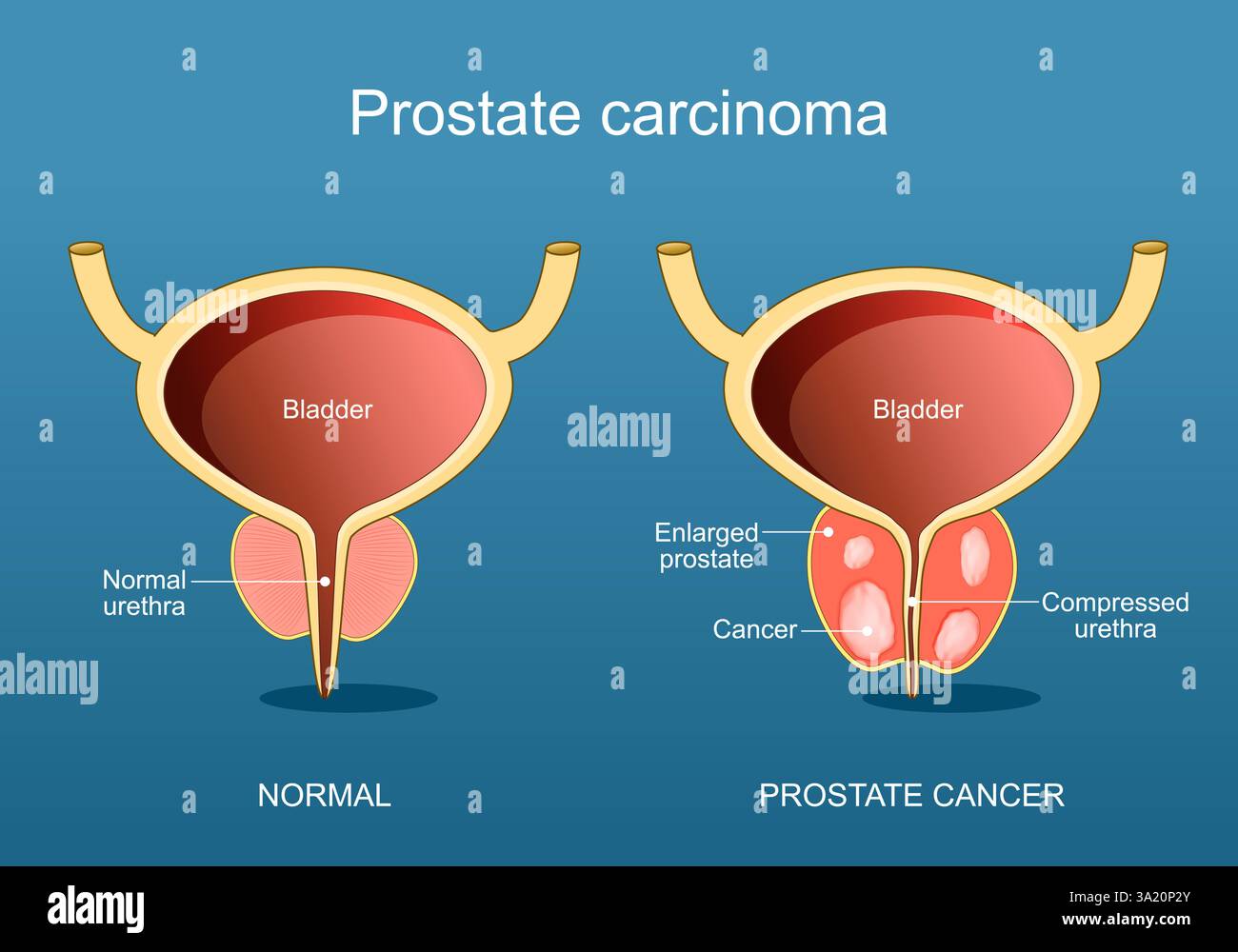 Prostate cancer. Adenocarcinoma. Cross section of a human bladder and Prostate gland. Disorder ...