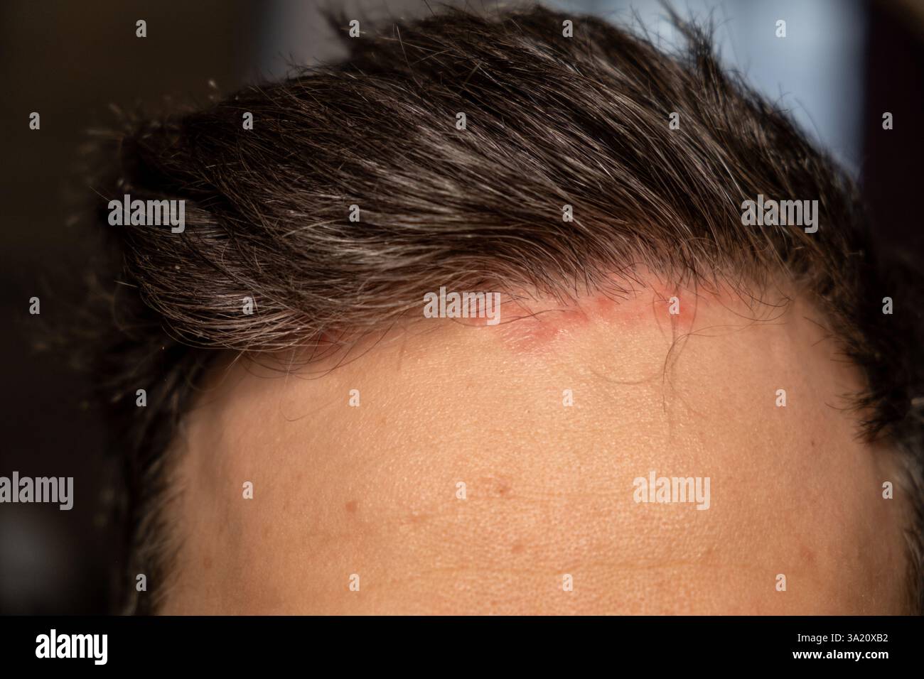 Management of psoriasis on the scalp with evident red, itchy patches in ...