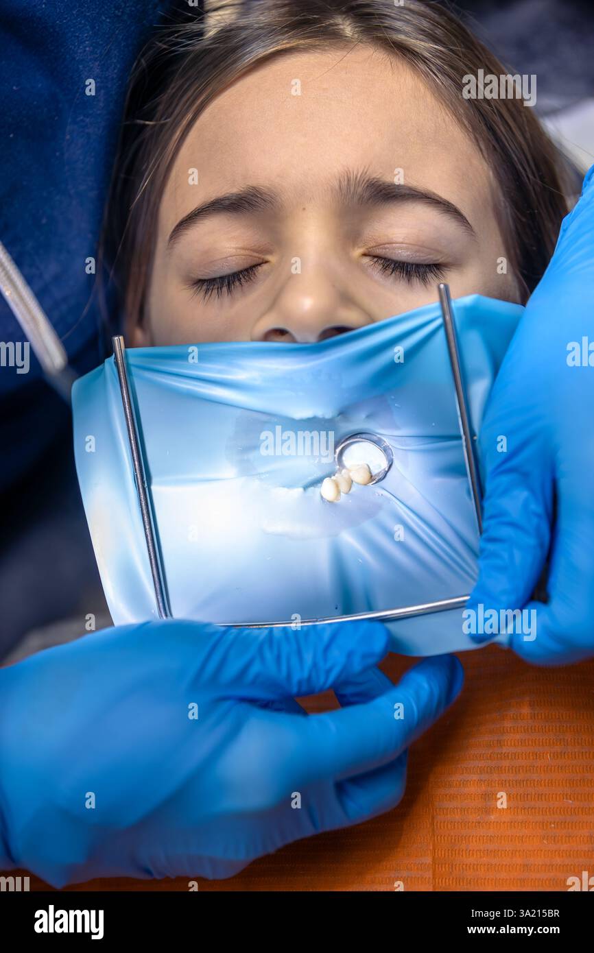 The dentist treats the child's tooth using a rubber dam. Close-up of ...