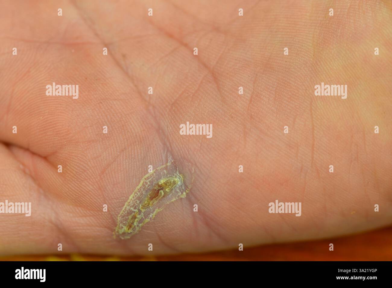 Wound healing on the hand. Healed wound on the palm of the hand. The ...