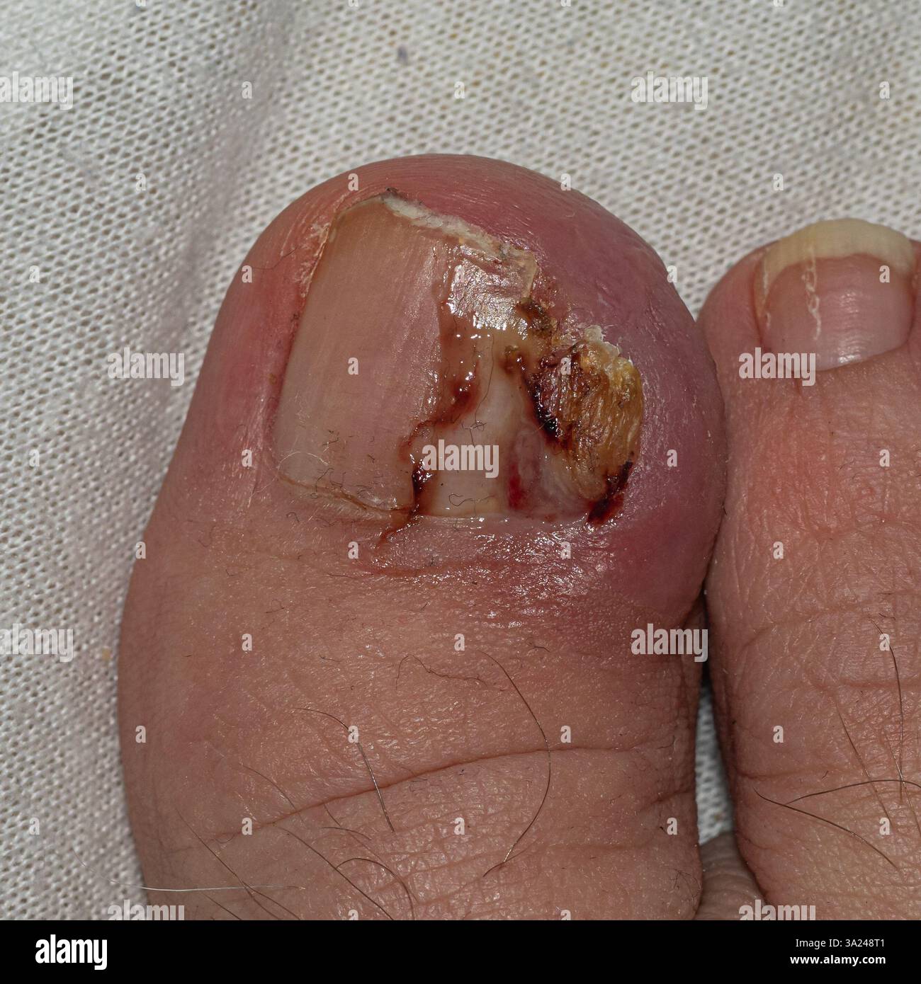 view of a damaged toenail on a human foot, showing signs of injury and ...