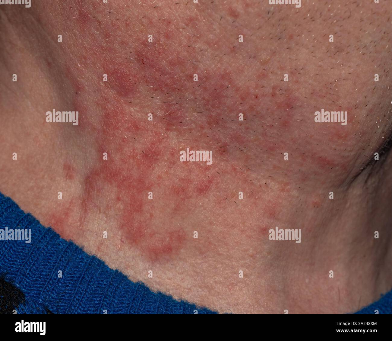 This image captures a detailed close-up of a red rash on a neck ...