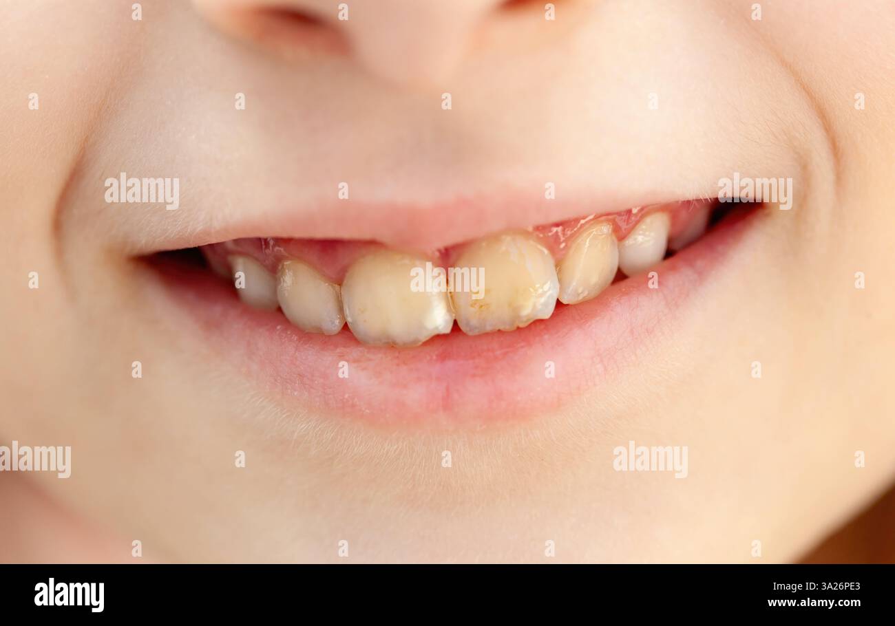 Close up of a child's smile revealing teeth affected by ...