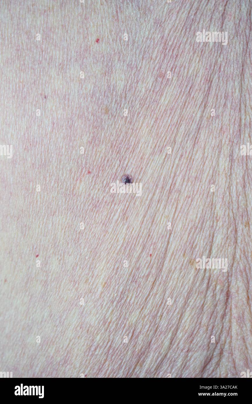 Moles and Skin Cancer Hidden Dangers on Aged Womens Skin. High quality ...