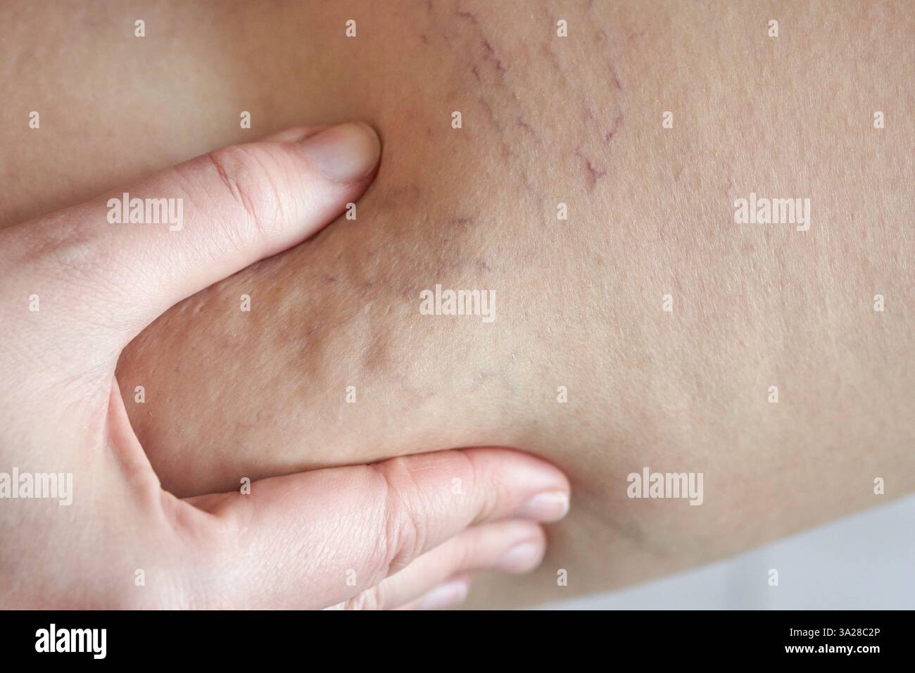 Close up of cellulite and stretch marks on caucasian female skin with ...