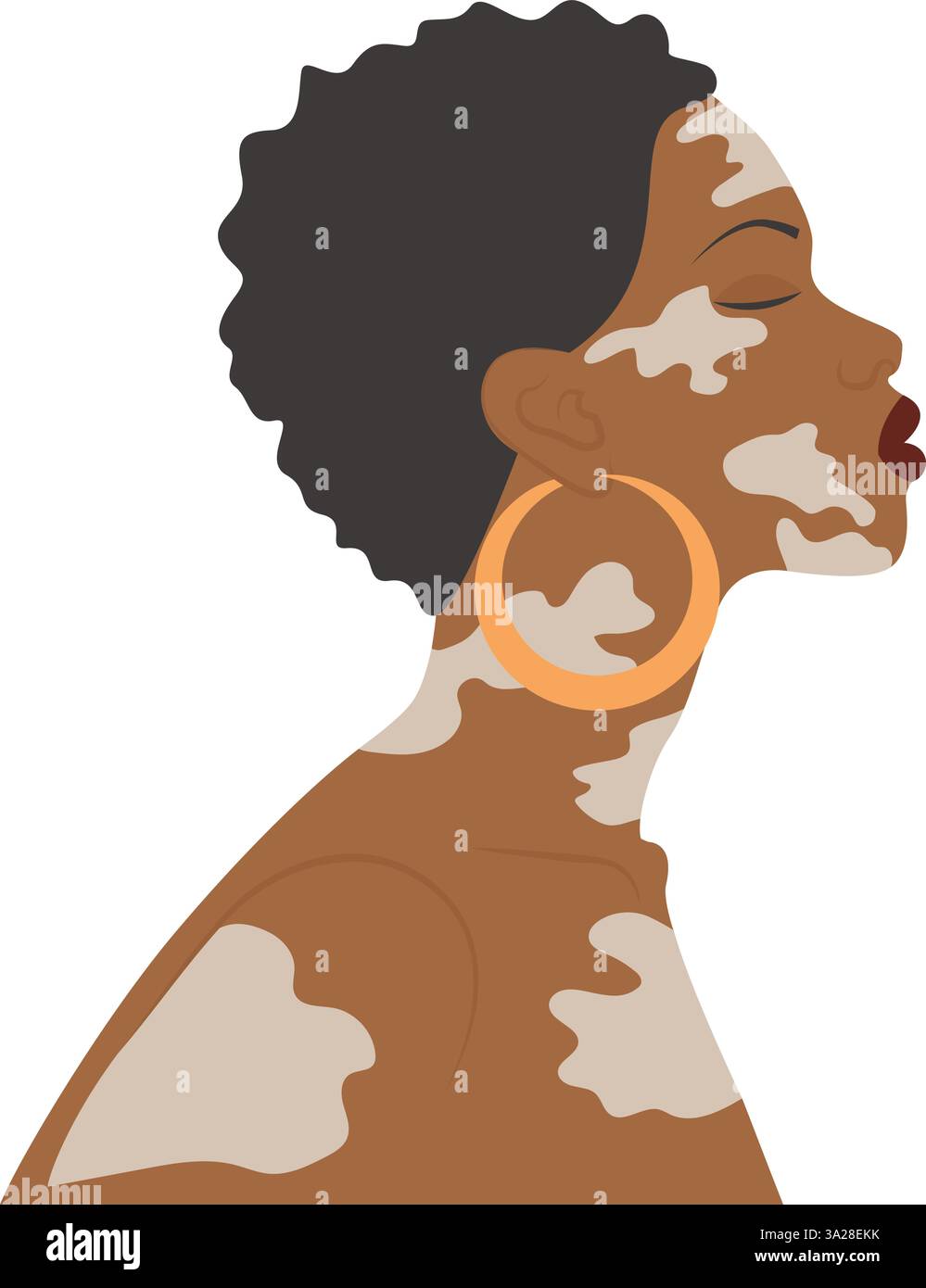 Afro-american woman illustration with vitiligo. World Vitiligo Day ...