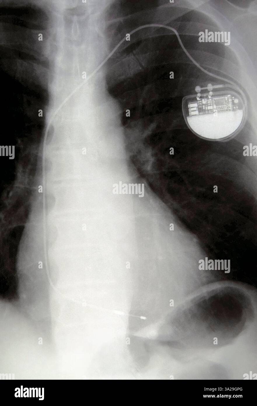 X- Ray of a pacemaker Stock Photo - Alamy