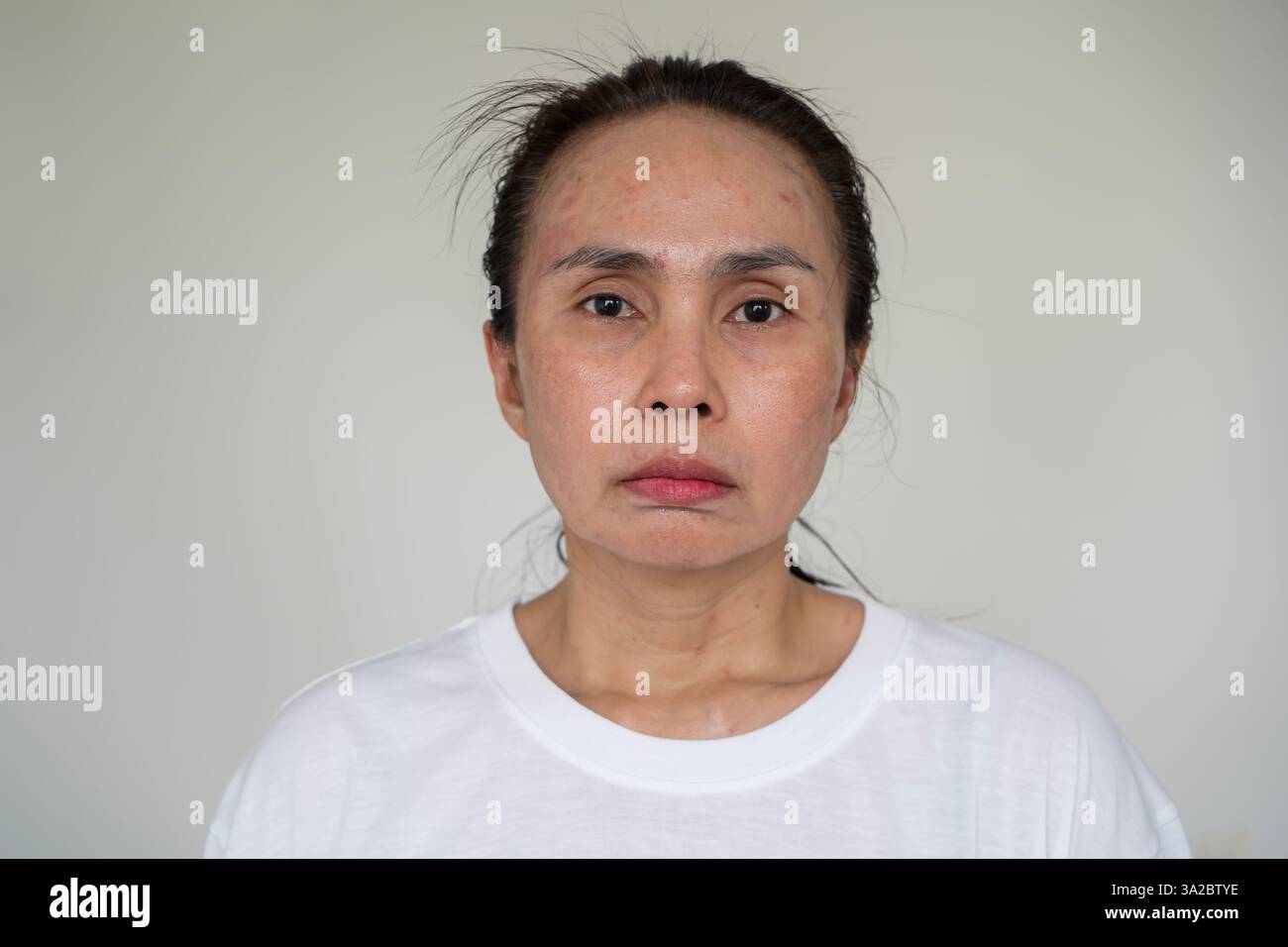 Portrait of Asian woman with acne problem occur on her face. Cropped ...