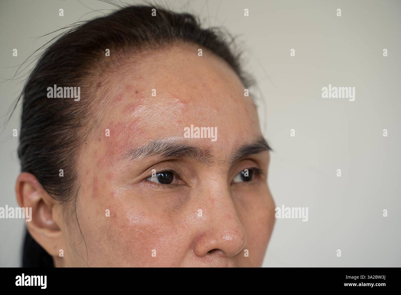 Asian woman with acne problem occur on her face. Cropped shot of young ...