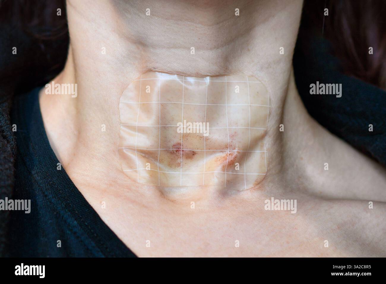 Waterproof transparent bandage on woman's throat with wounds after ...