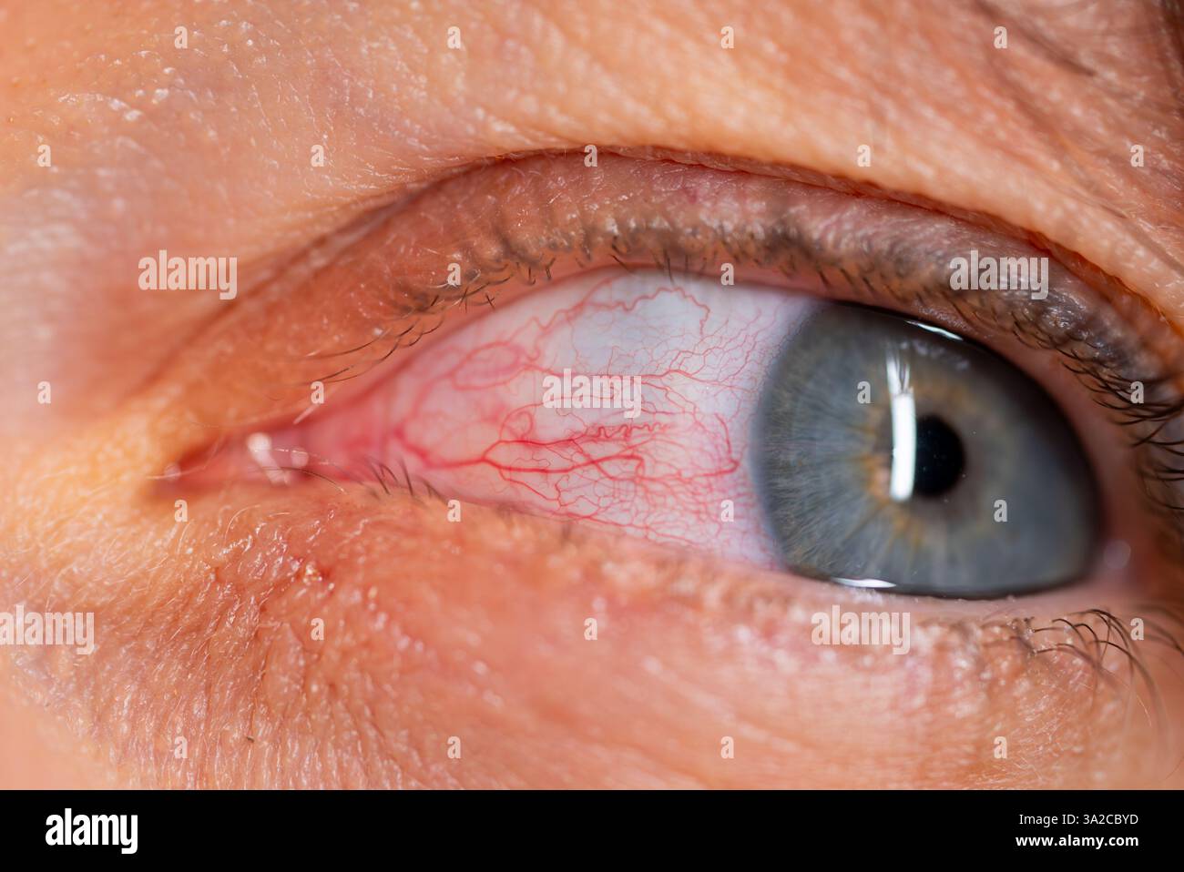 Red irritated eye showing prominent capillaries and signs of infection ...