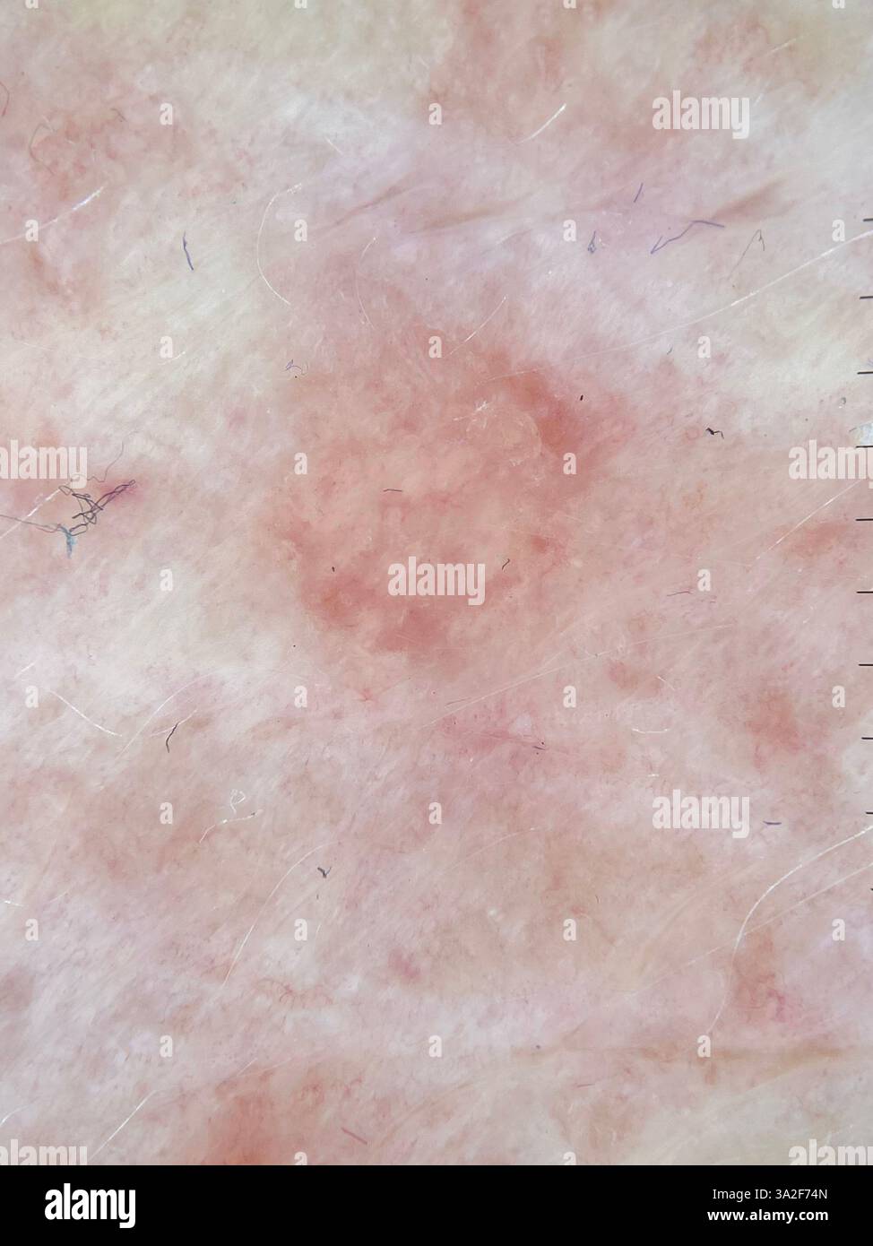 Infiltrative basal cell carcinoma, dermoscopy Stock Photo - Alamy