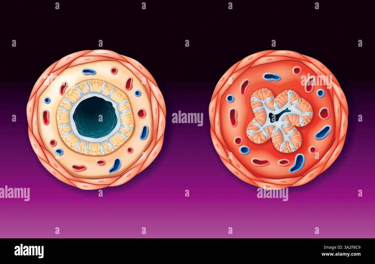 Artwork of a cross-section through a healthy (at left) and asthmatic ...