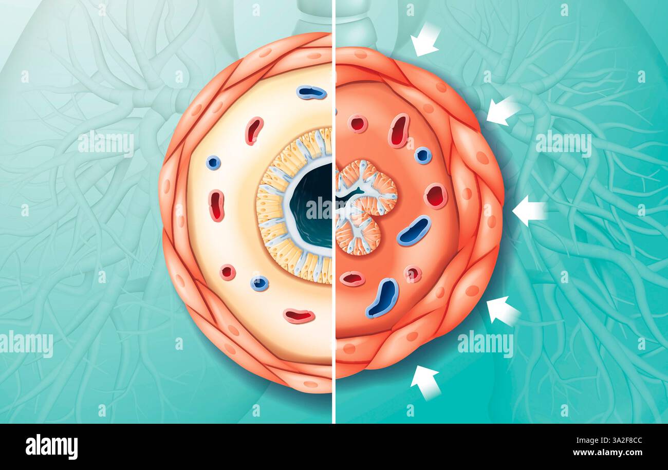 Artwork of a cross-section through a healthy (at left) and asthmatic ...