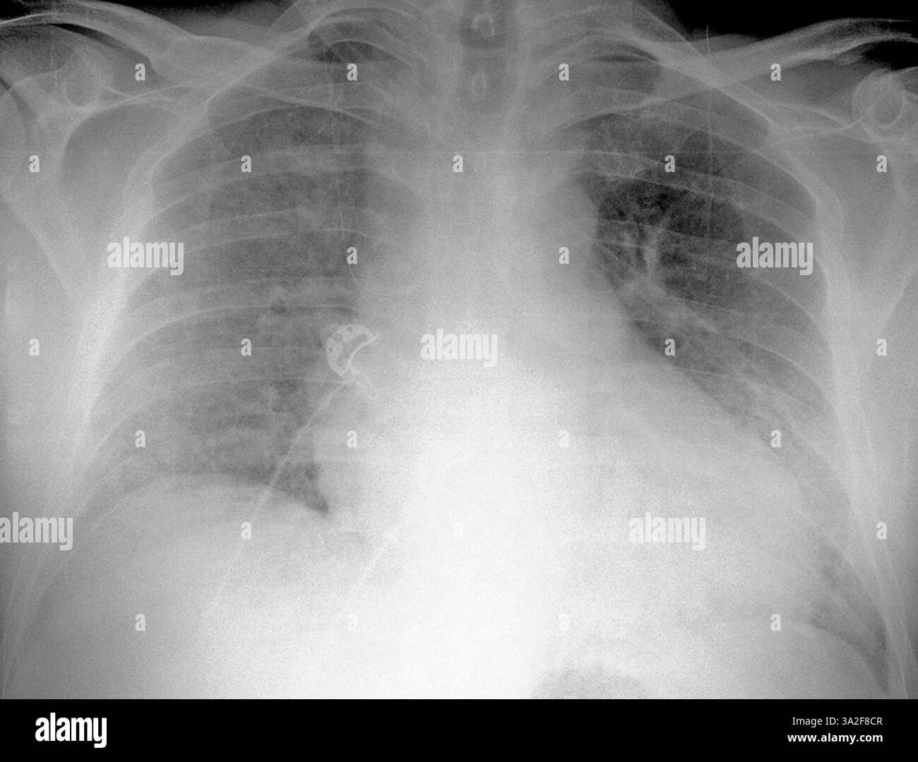 Pneumocystis pneumonia. Frontal chest X-ray of a male patient with ...