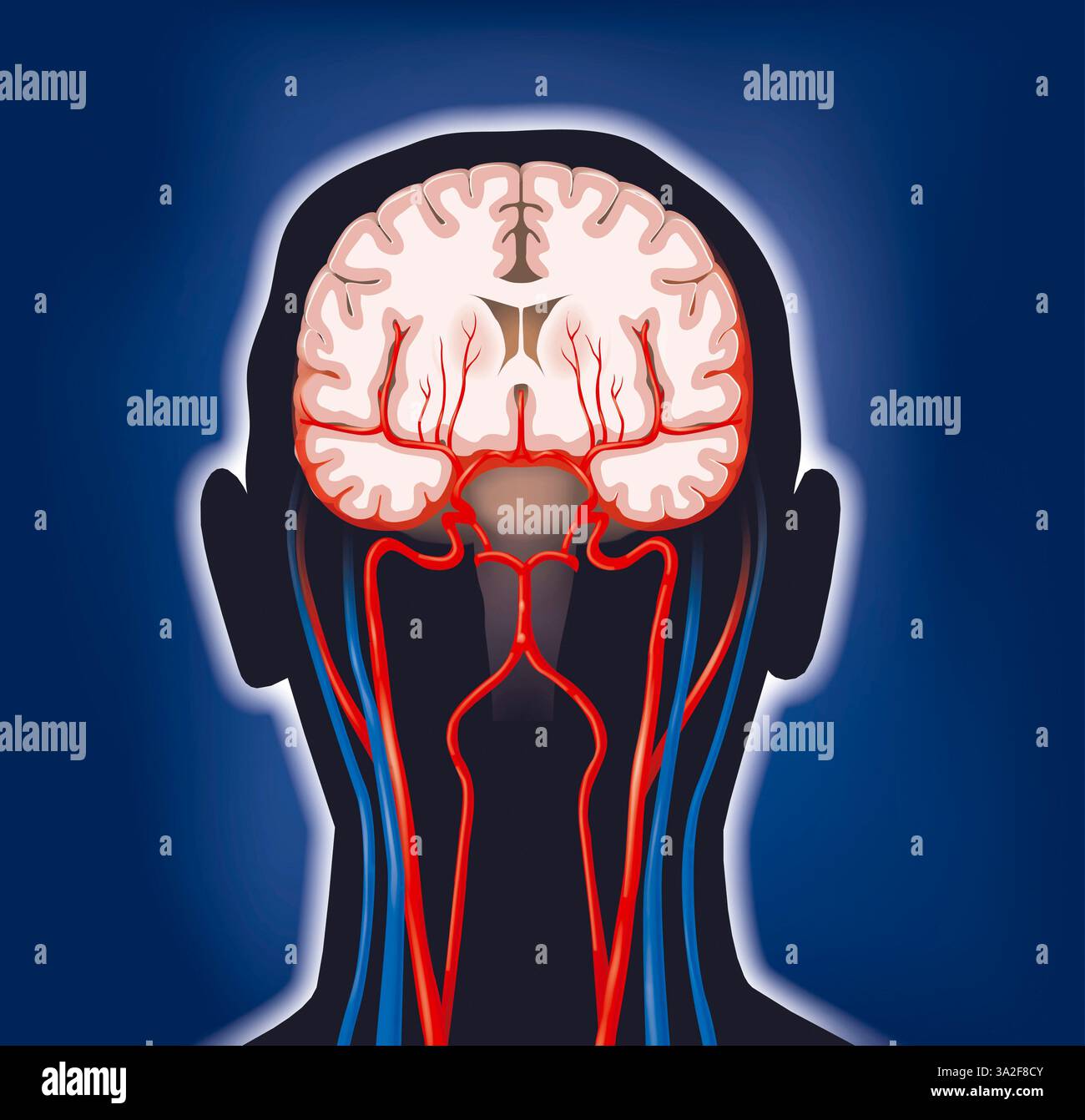 Brain haemorrhage. Computer artwork of a section through a brain and ...