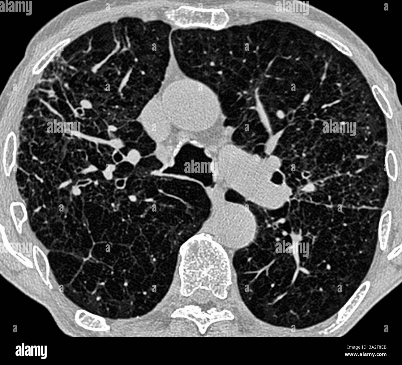 emphysema-computed-tomography-ct-scan-of-an-axial-section-through