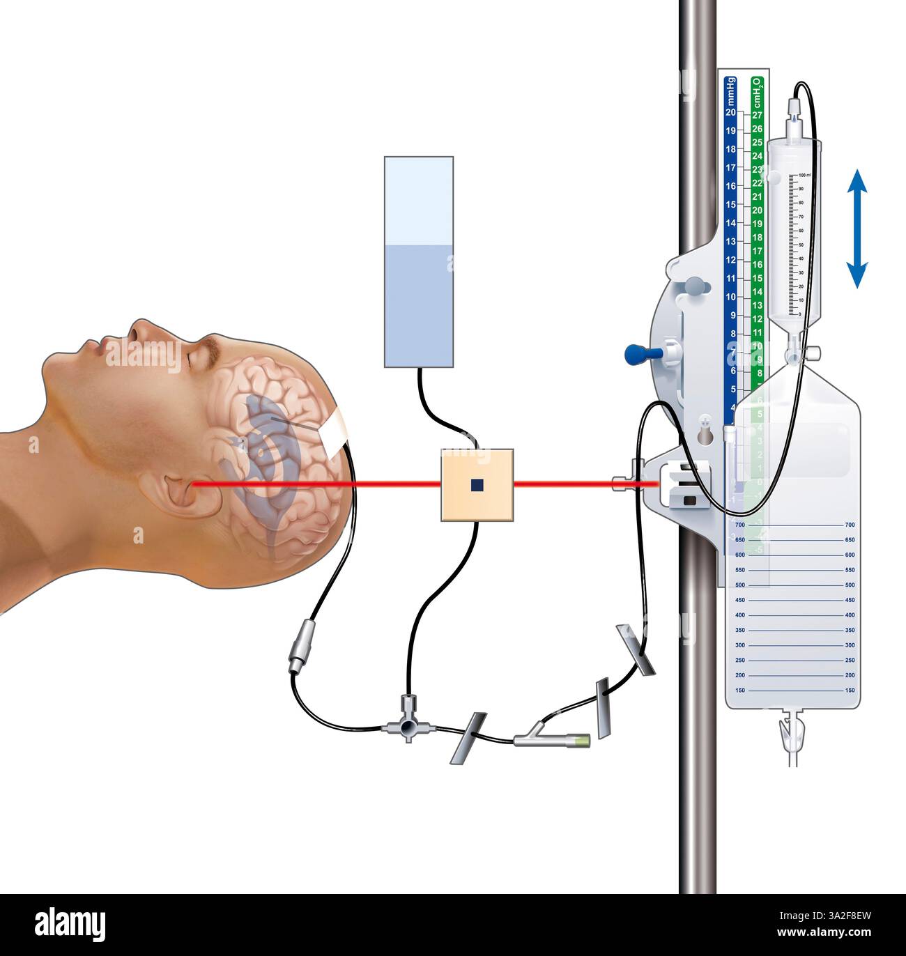 Ventricular shunt. Computer artwork showing a ventricular shunt being ...