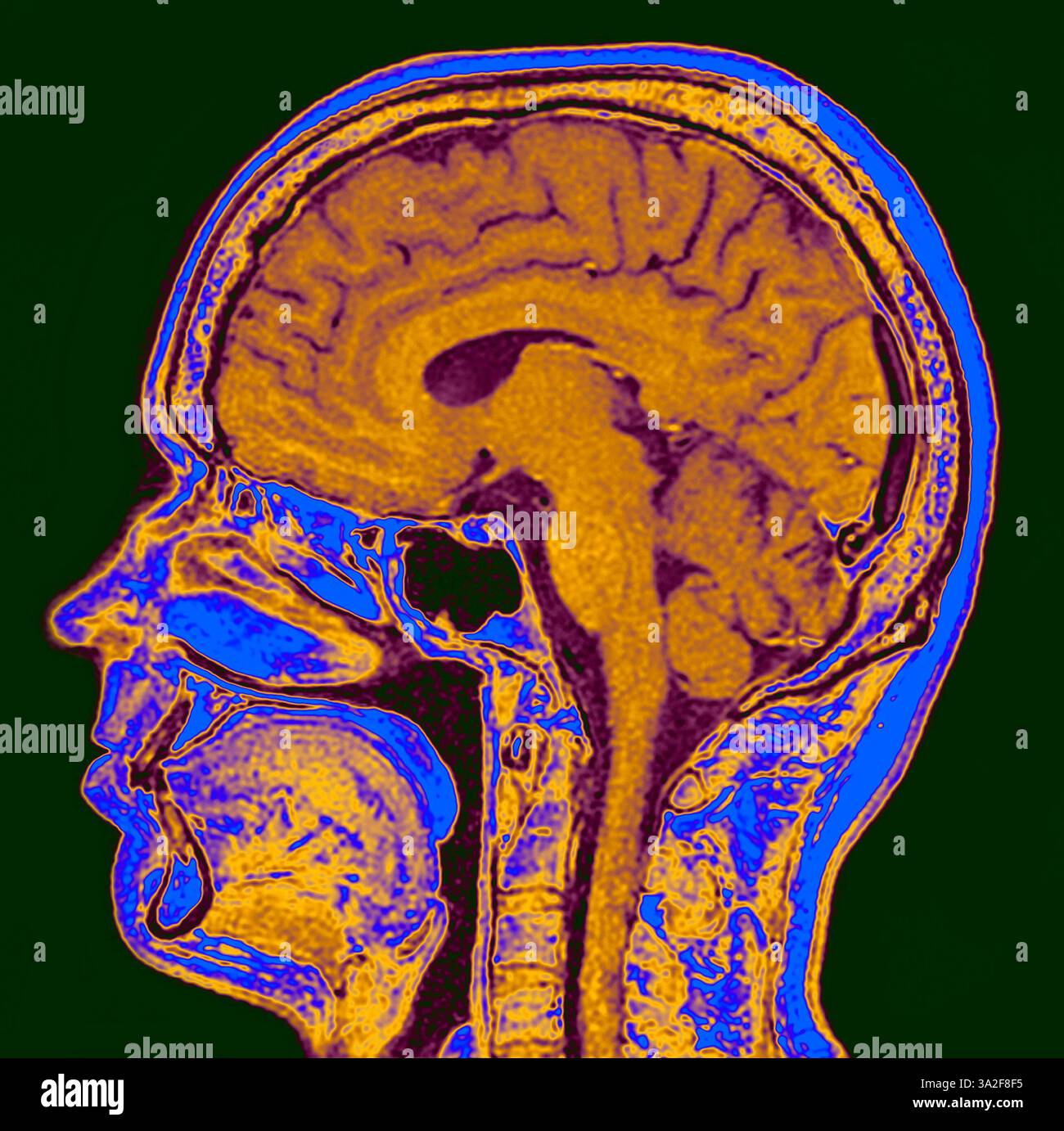 Normal brain. Coloured magnetic resonance imaging (MRI) scan of a sagittal section through the ...