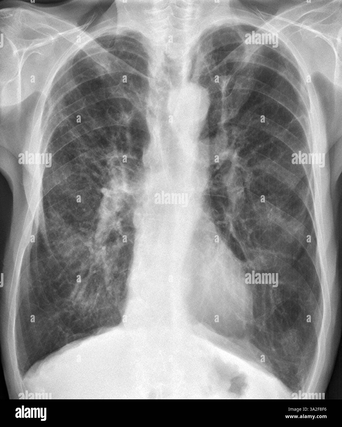 Emphysema. Frontal chest X-ray of a male patient with diffuse pulmonary ...