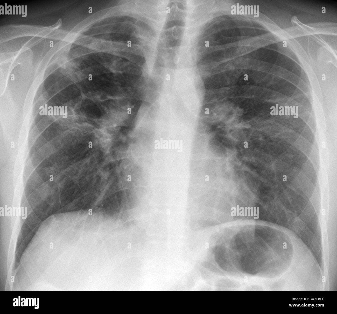 Berylliosis. Frontal chest X-ray of a male patient with chronic ...