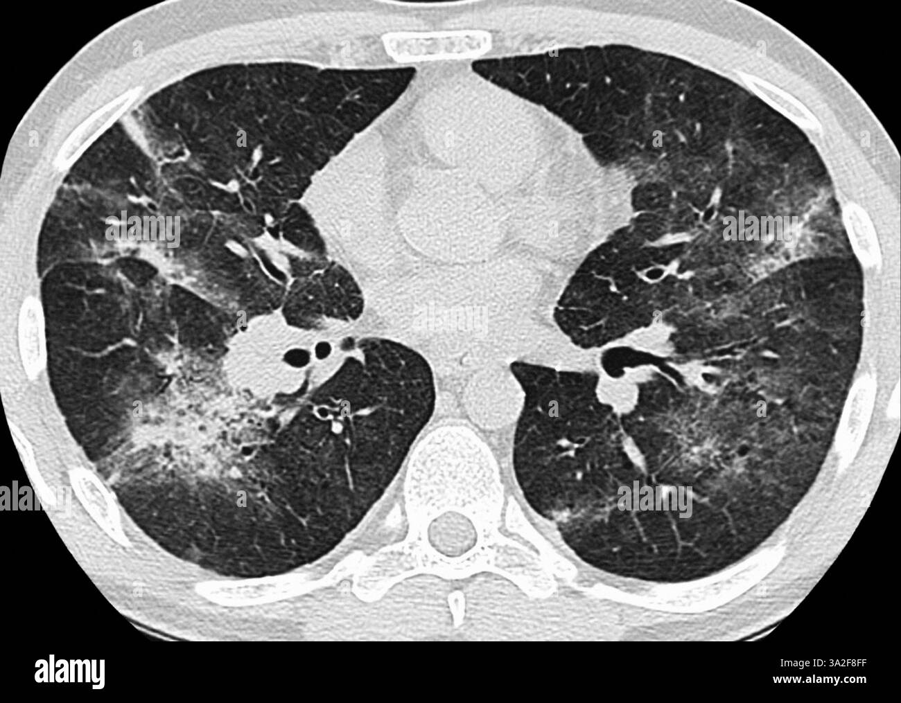 Berylliosis Computed Tomography Ct Scan Of An Axial Section Through