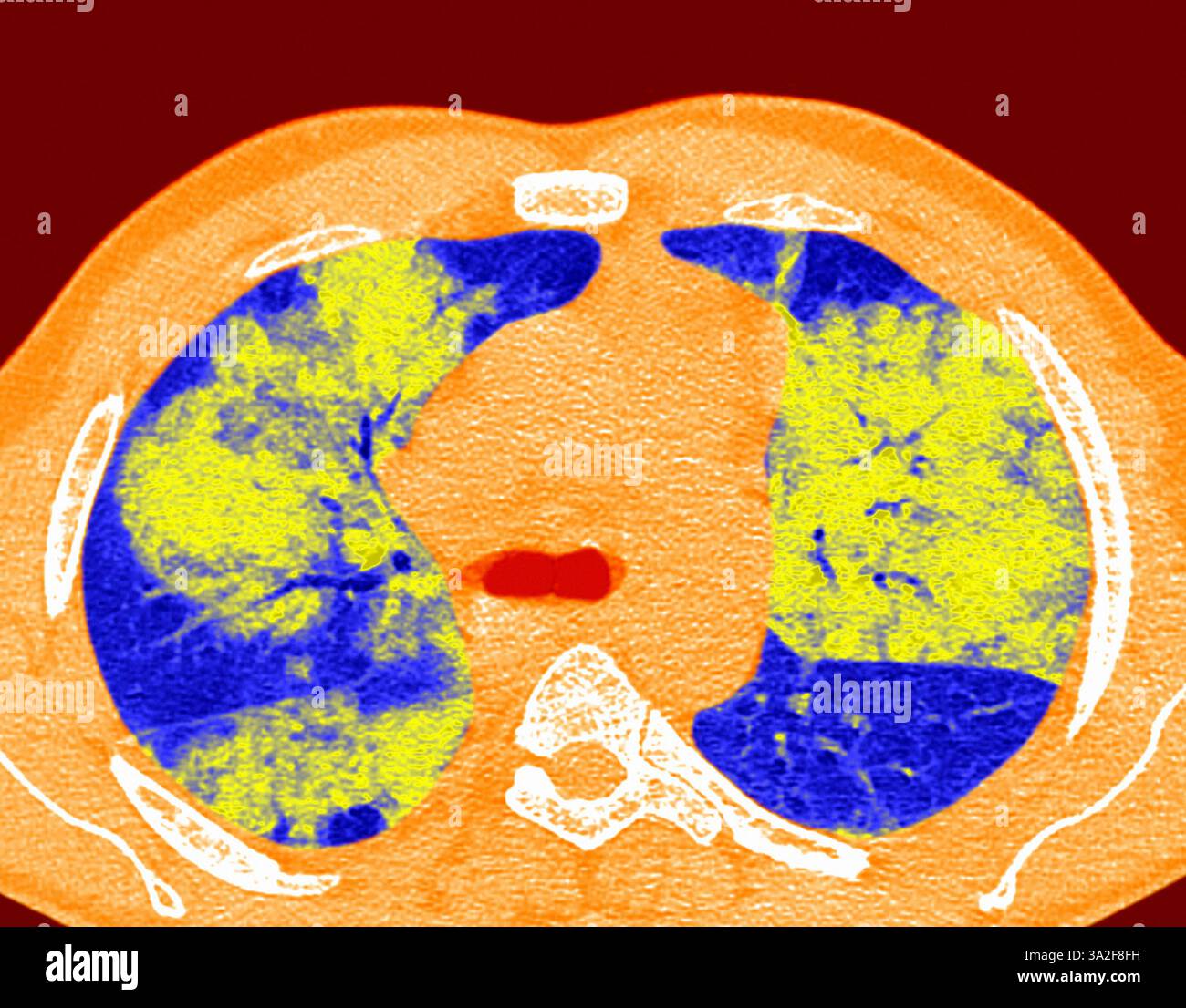 Pneumonia. Coloured computed tomography (CT) scan of an axial section through the chest of a 60 ...