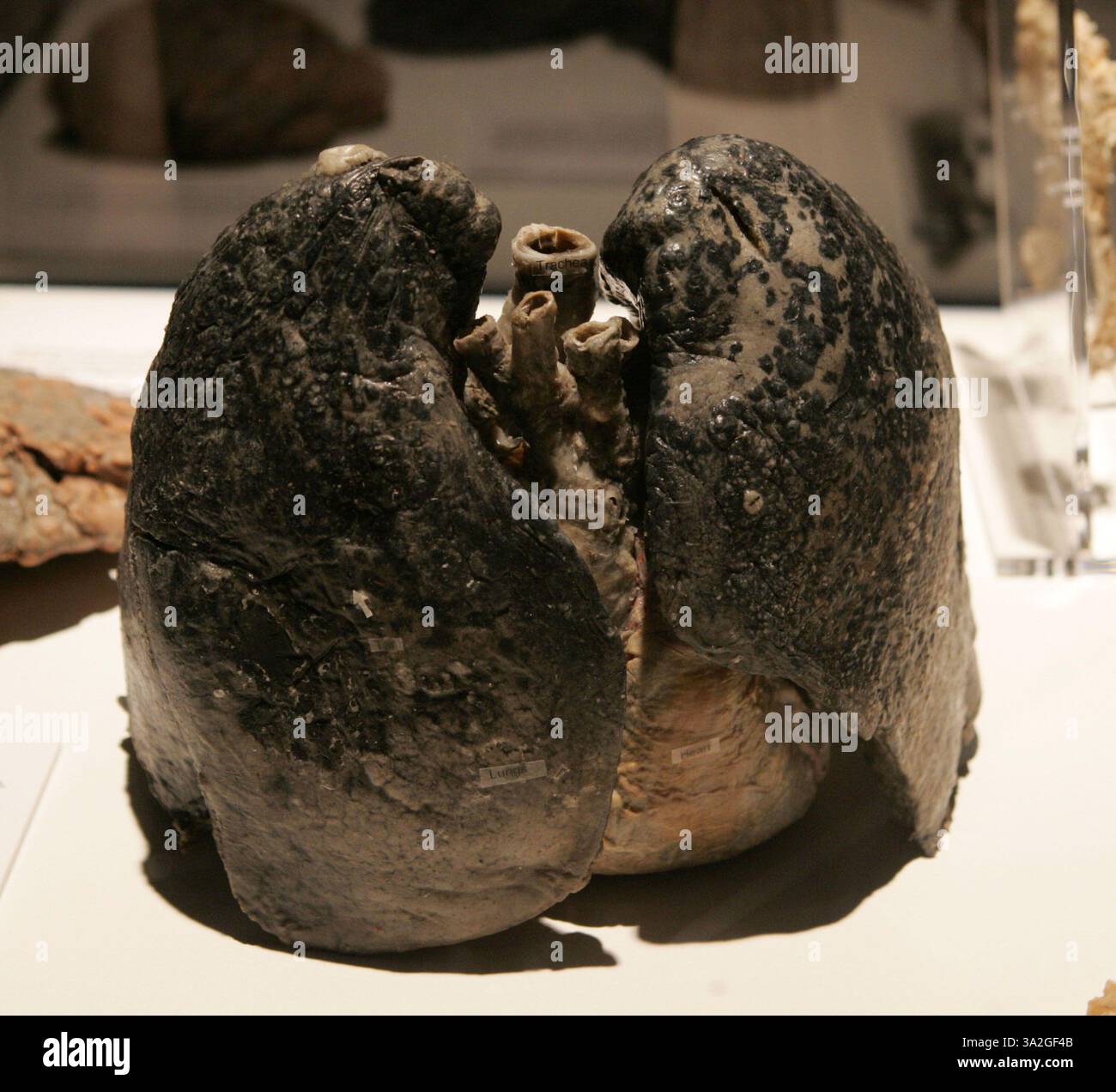 Nov 19, 2005; New York, NY, USA; A view of a smokers black lungs and ...