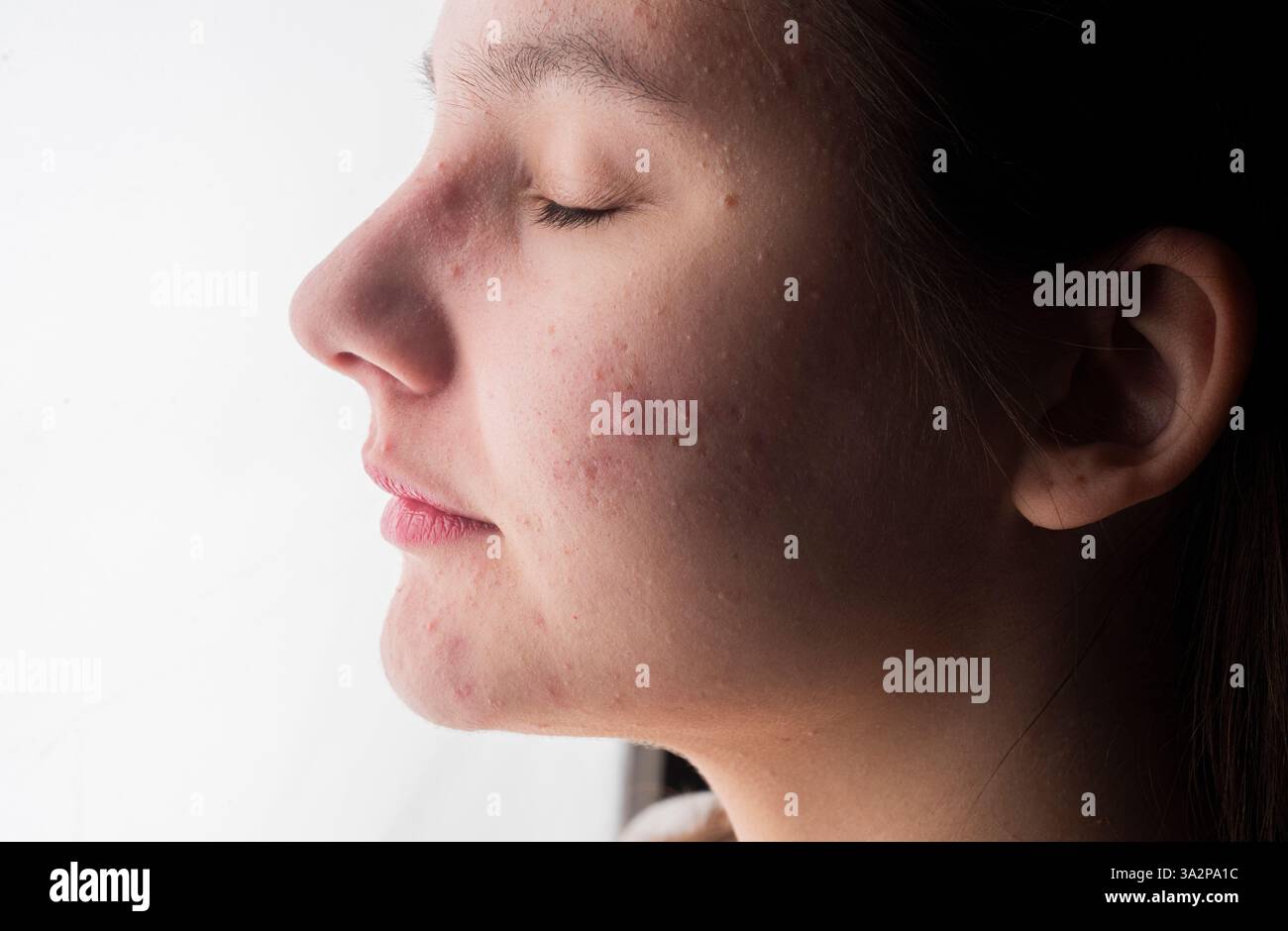 Skin acne background. Closeup acne pimple on girl skin. Treatment for ...