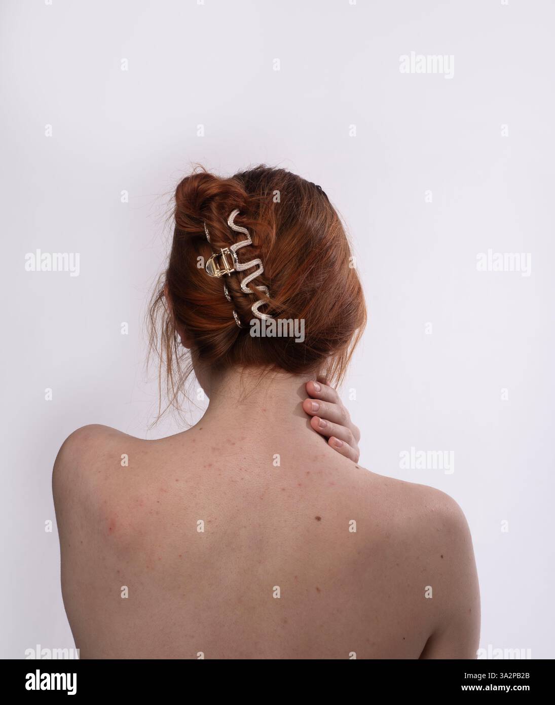 Acne skin. Skin acne background. Acne problem on back. Dermatology and ...