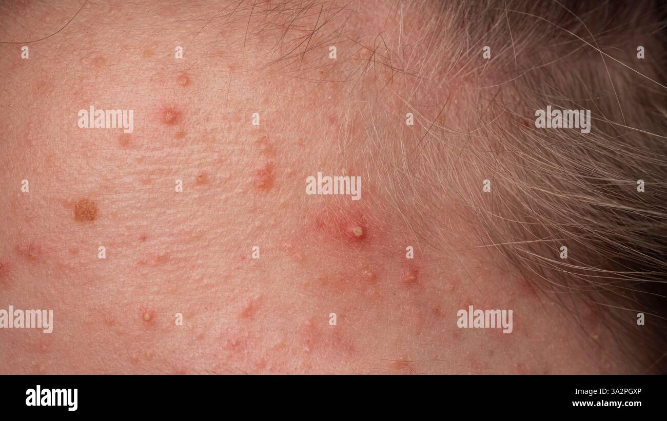 Many Pimples Girl With Bad Skin Hormonal Acne Puberty Skin Acne