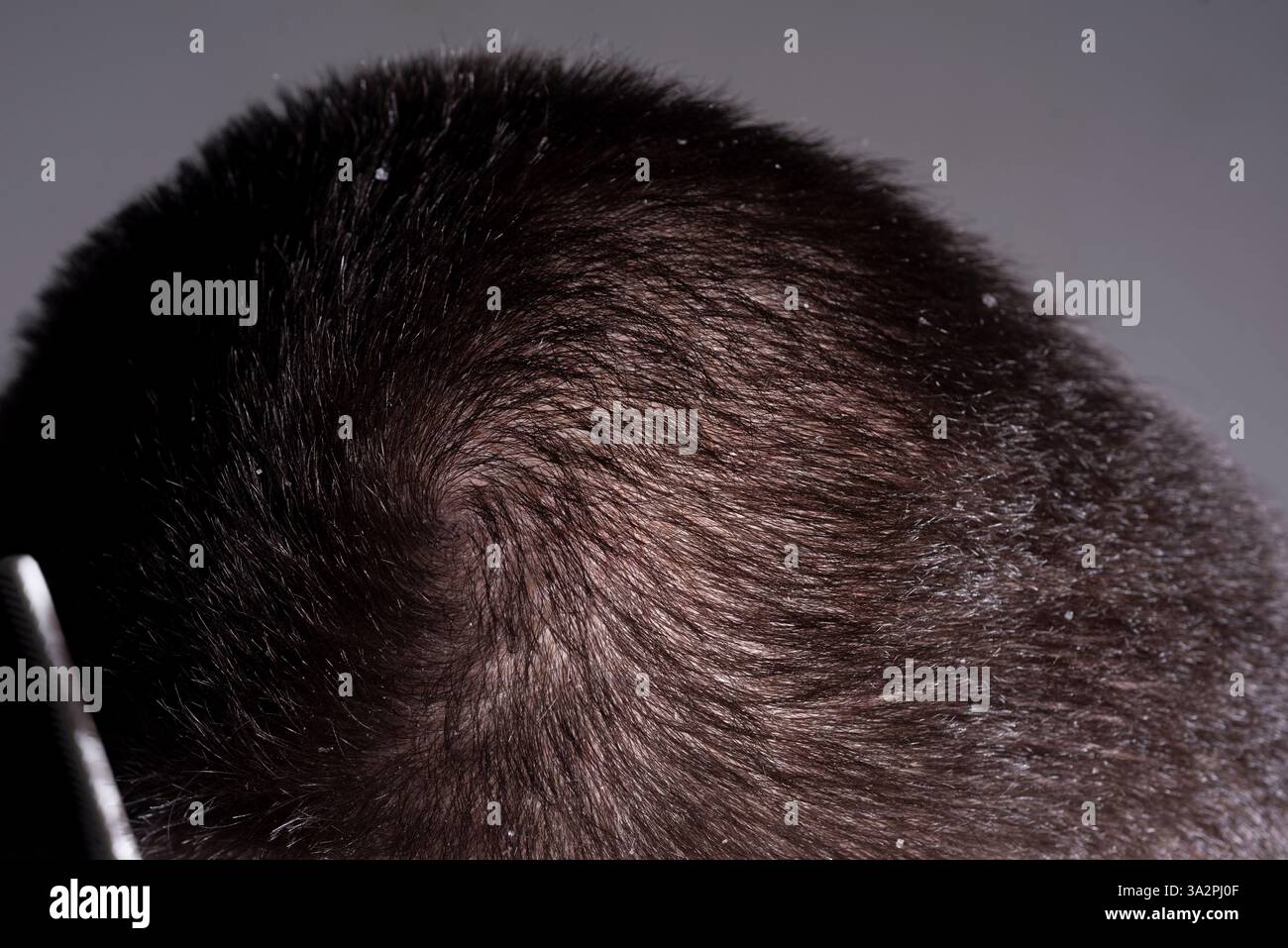 Shampoo. Dandruff hair. Messy hair. Hair with dandruff. Scalp problem ...