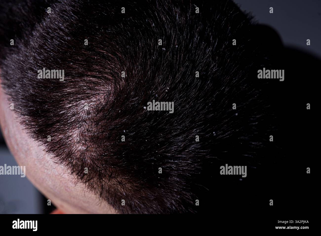 Dermatology shampoo. Dermatitis or eczema. Problem of dandruff ...