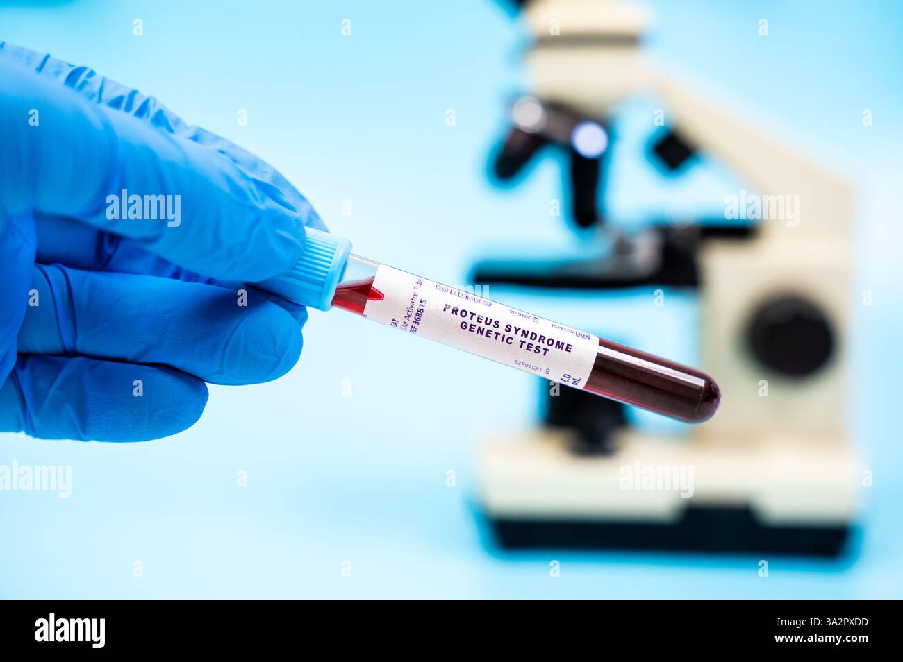 Identifies mutations in the AKT1 gene, causing Proteus syndrome ...