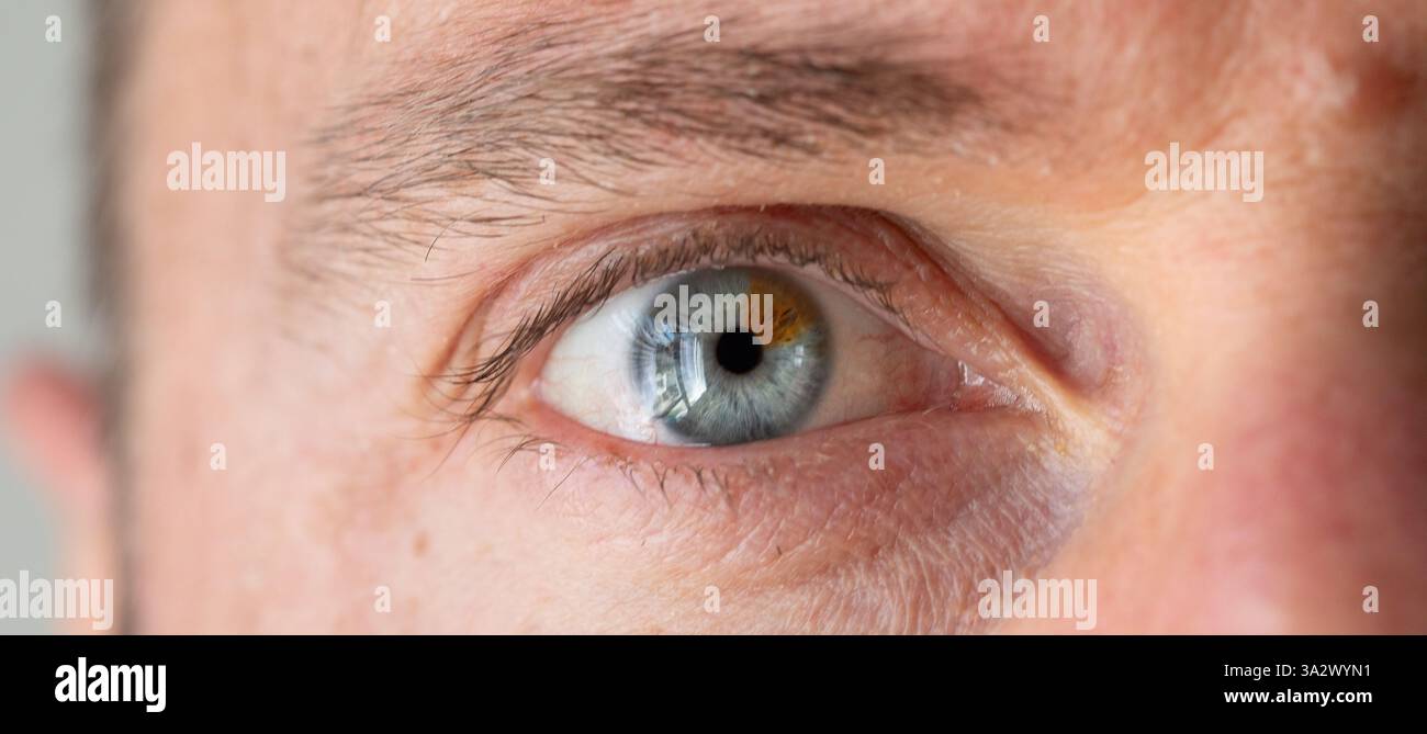 Close-up of a human eye showing central heterochromia, a condition ...
