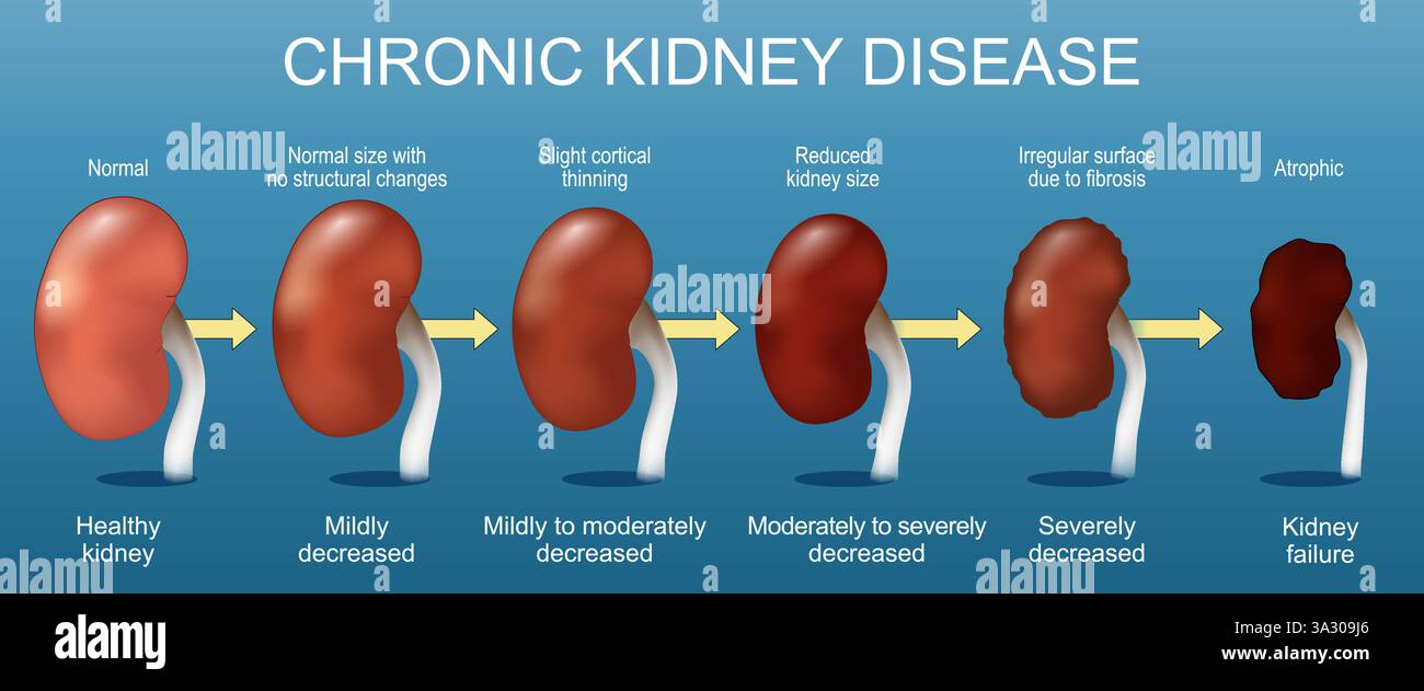 Chronic kidney disease. Stages of CKD from Healthy kidney to decreased Glomerular filtration ...
