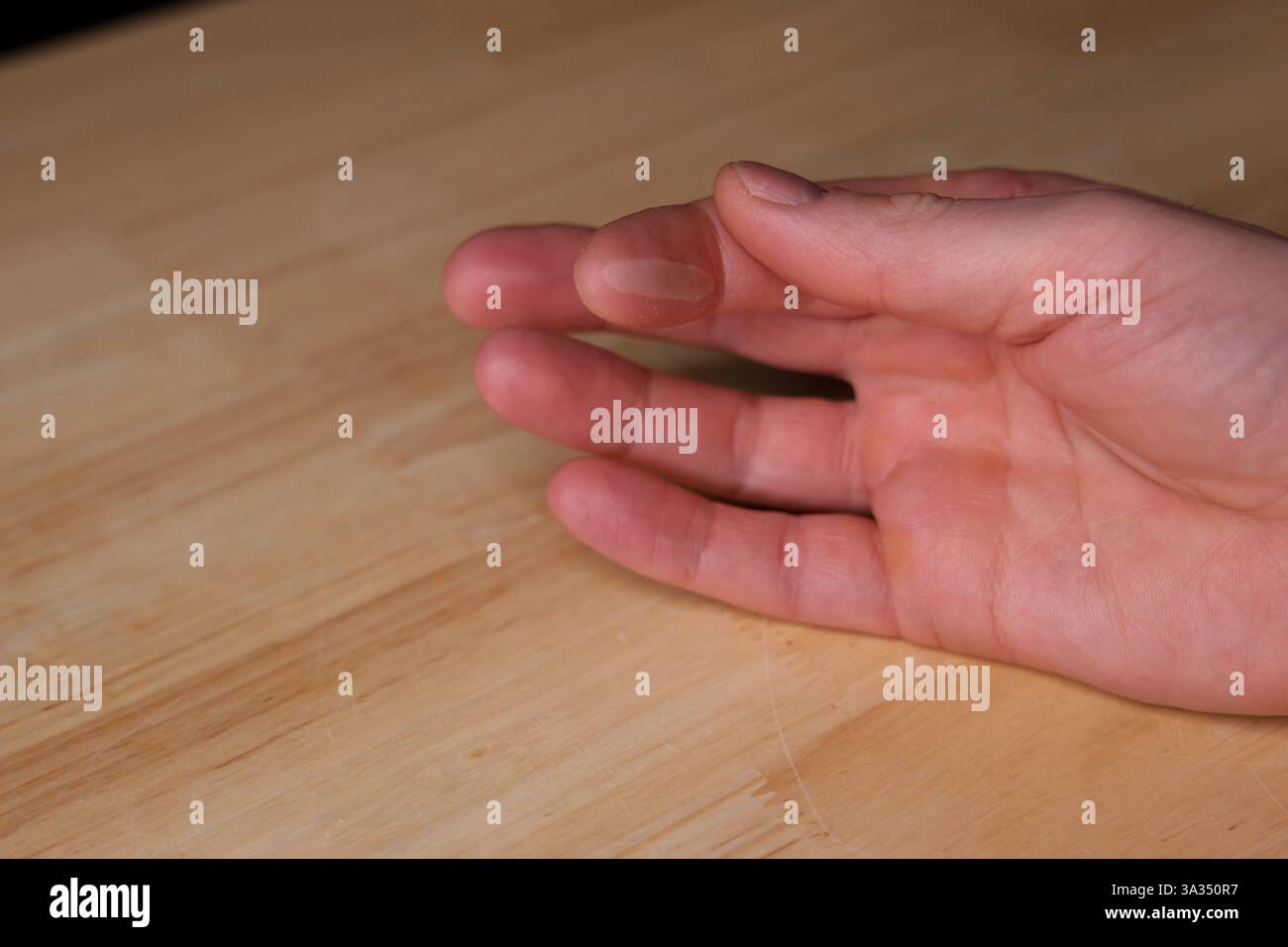 Blister on finger tip skin injury Stock Photo - Alamy