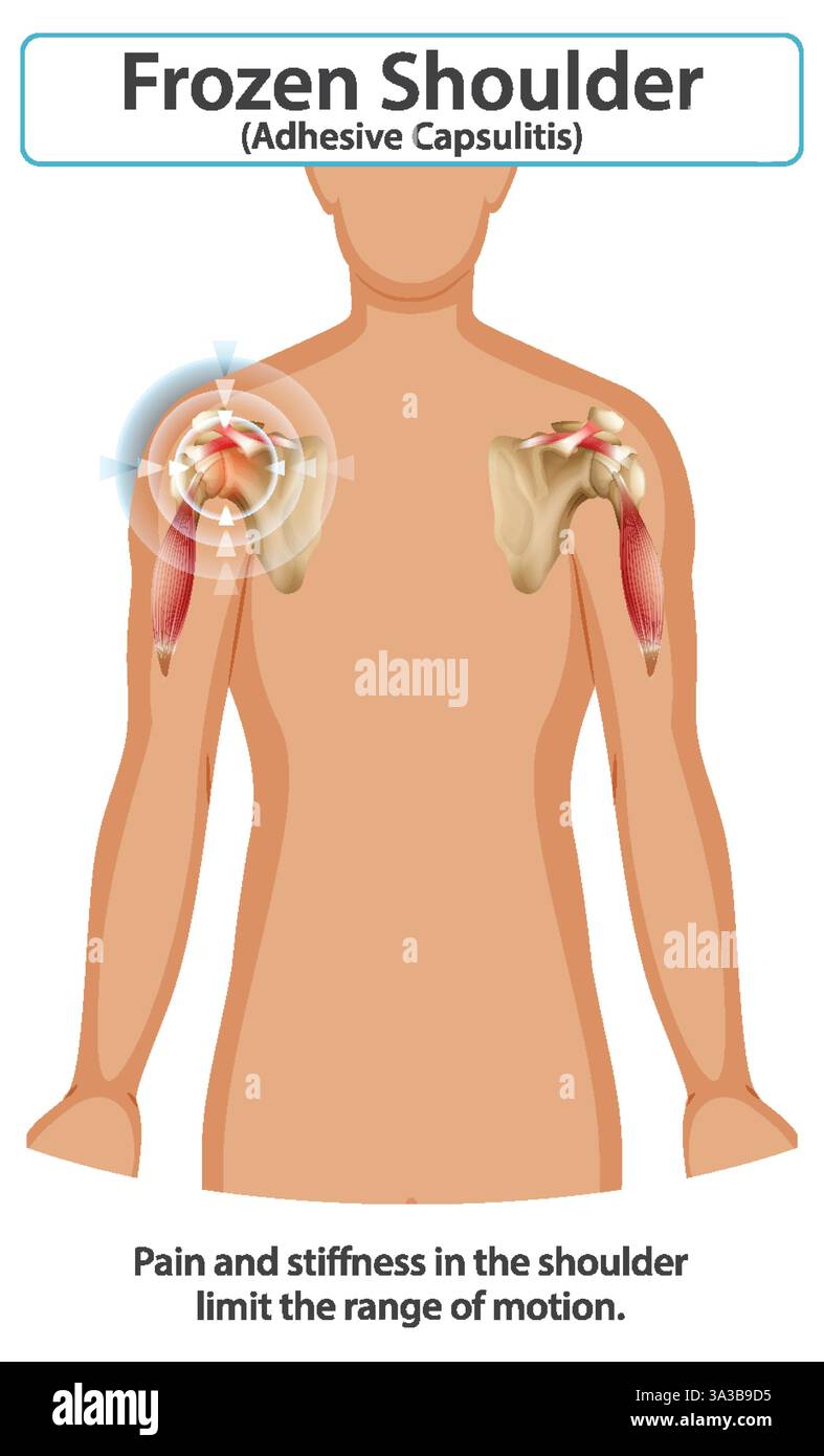 Illustration of shoulder anatomy and adhesive capsulitis Stock Vector ...