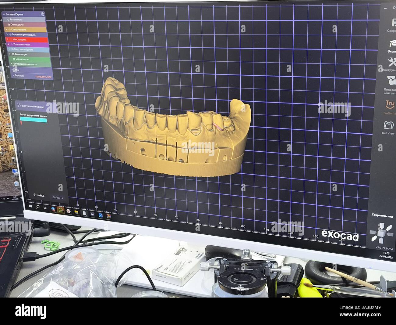 Digital dental model on computer screen with exocad software interface ...