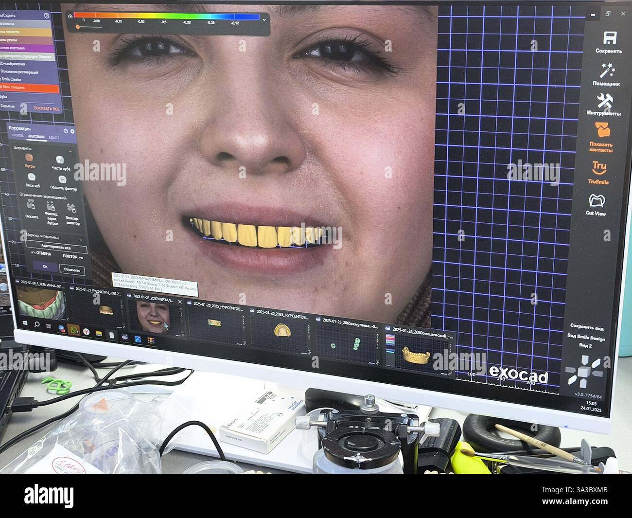 Dental software display with caucasian adult female teeth alignment ...