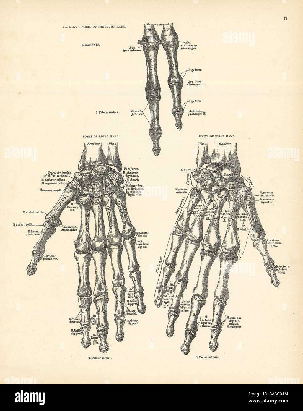 Anatomy. 4th & 5th Fingers, Bones of Right Hand 1880 old antique print ...