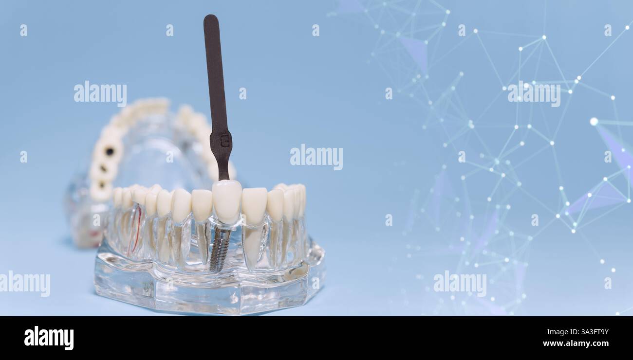 dental shade guide comparing tooth color on an implant model, with ...