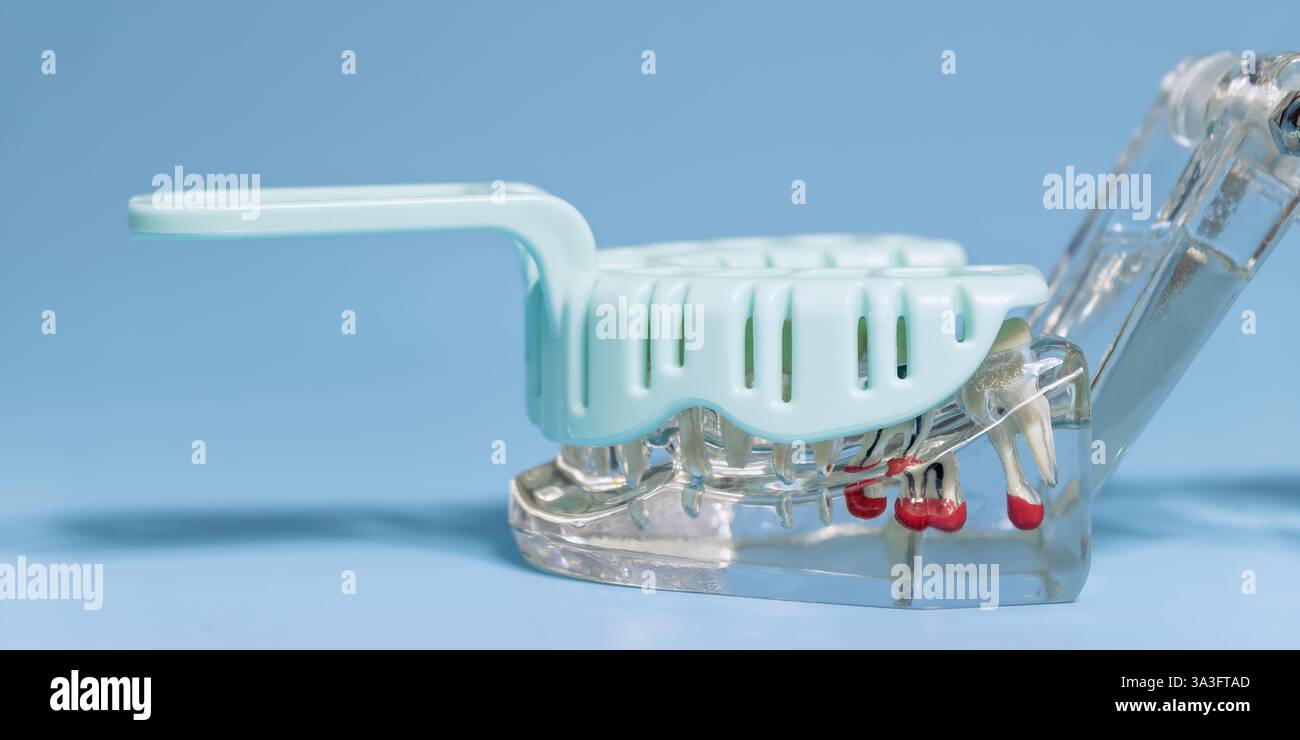 Dental impression tray on anatomical tooth model Stock Photo - Alamy