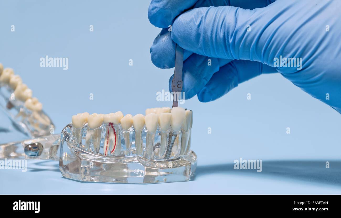 Tooth implant shade matching with dental guide Stock Photo - Alamy