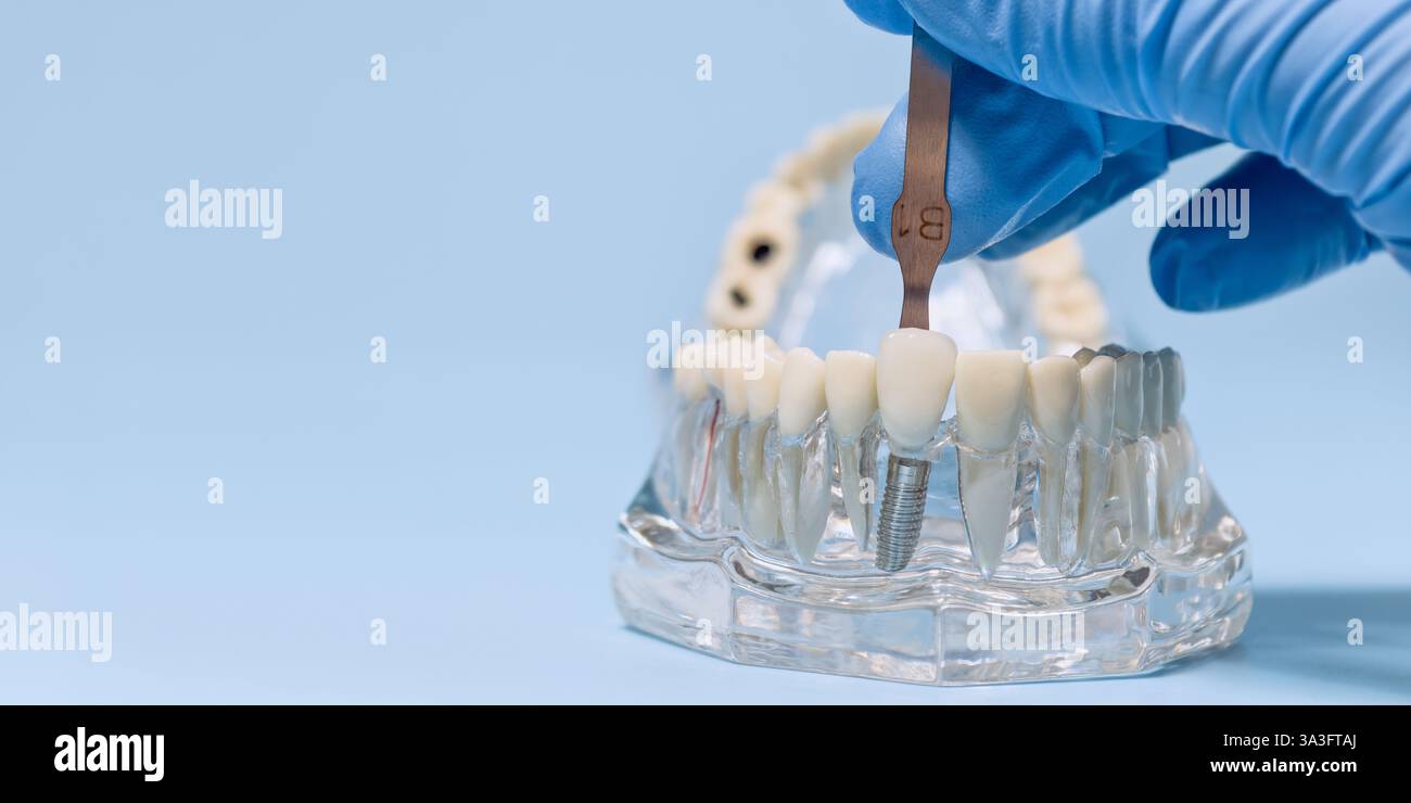 Dental implant color matching with shade guide Stock Photo - Alamy