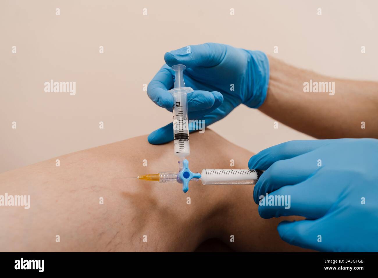 Sclerotherapy injecting into the varicose or spider vein on leg to ...