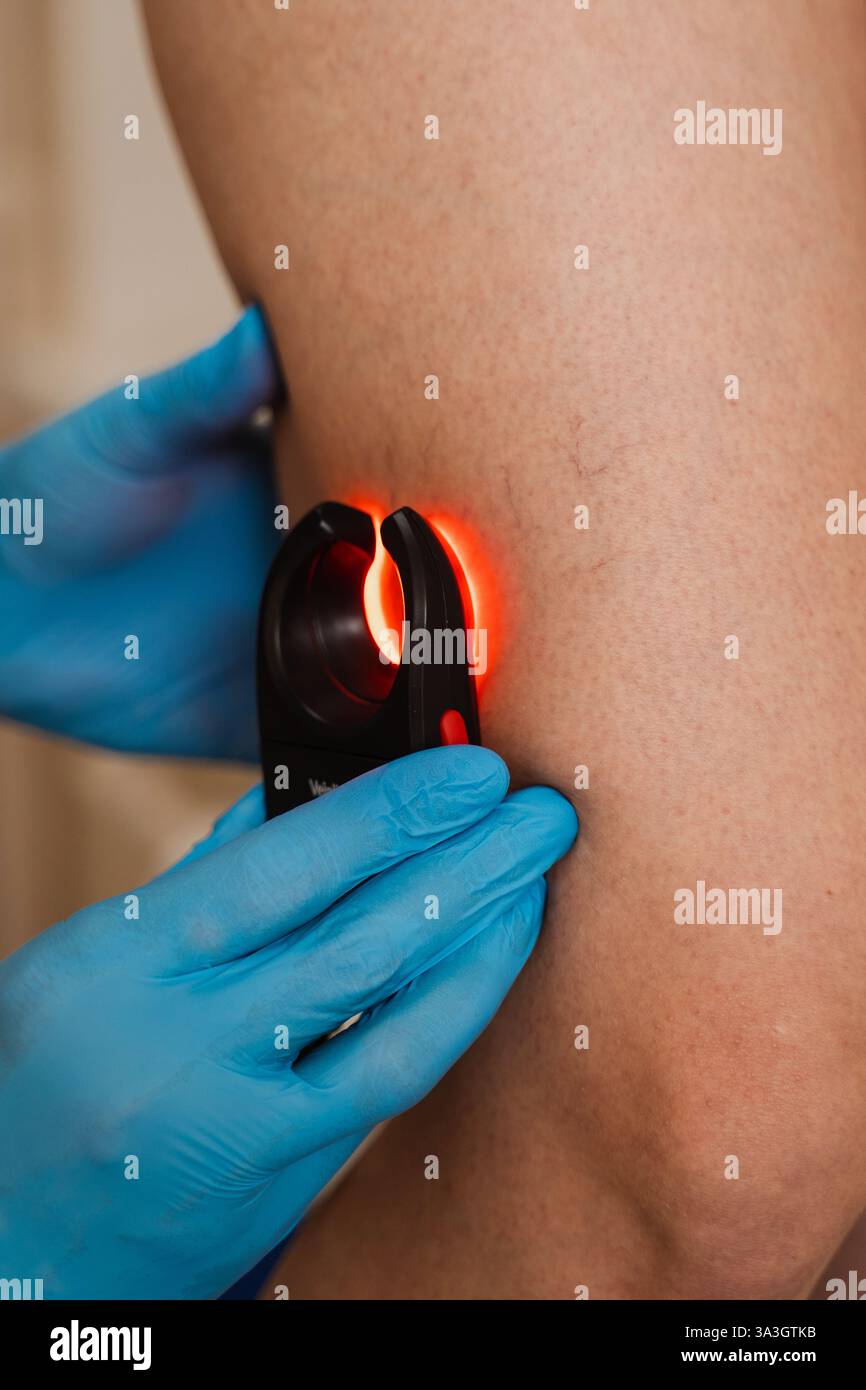 Vascular surgeon examines leg veins of woman using led venous scanner ...